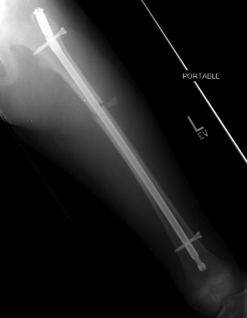 Medical Apparatus Imaging Guide: fracture fixation