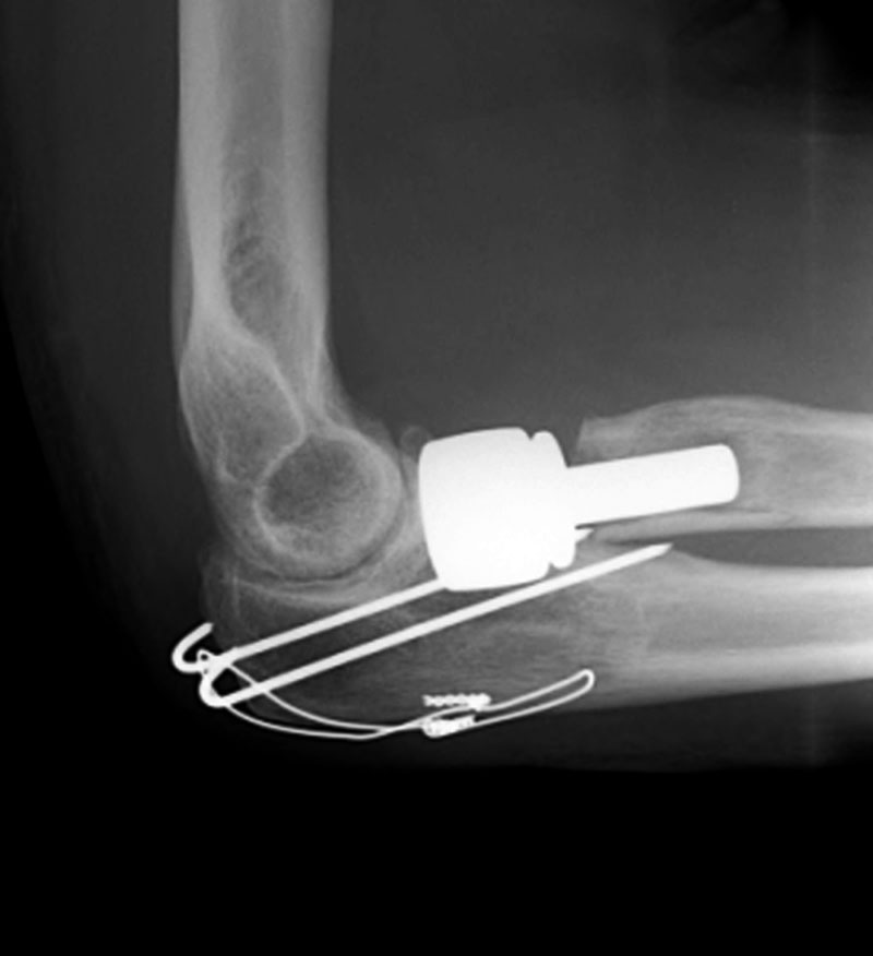 Joint Arthroplasty: a gallery
