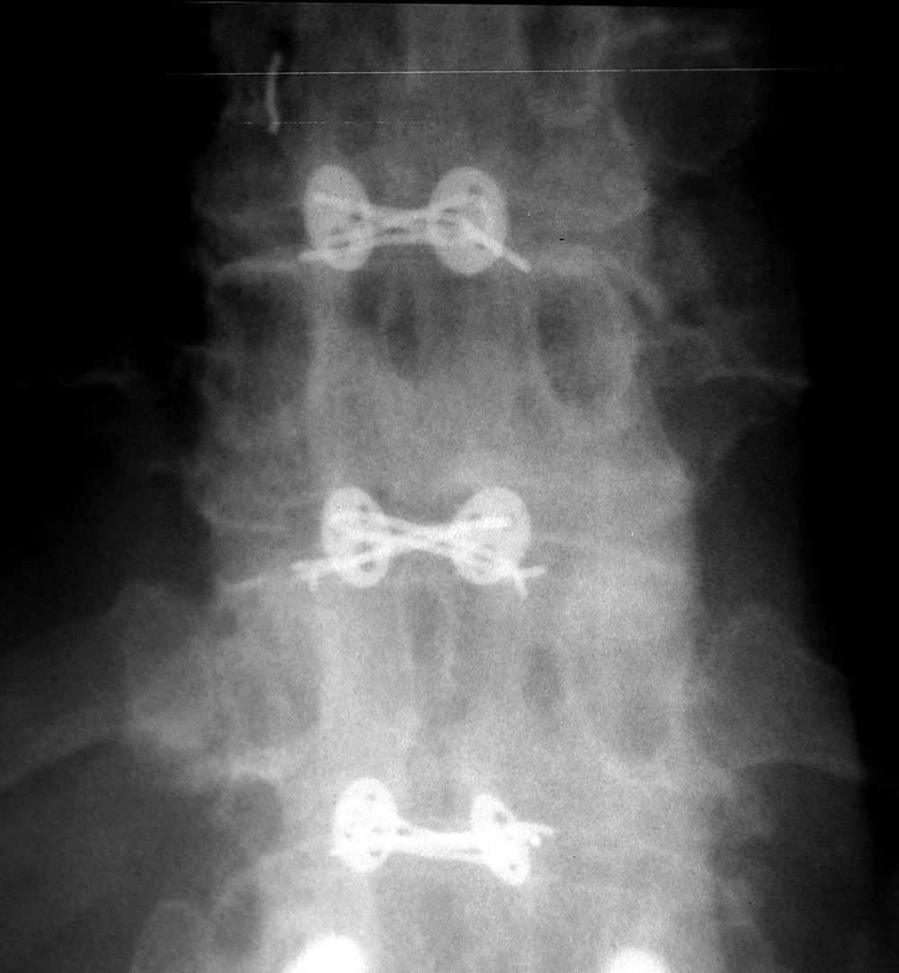 Medical Devices of the Neck and Spine: an imaging guide